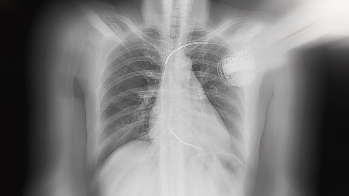 Când este necesară implantarea unui stimulator cardiac?